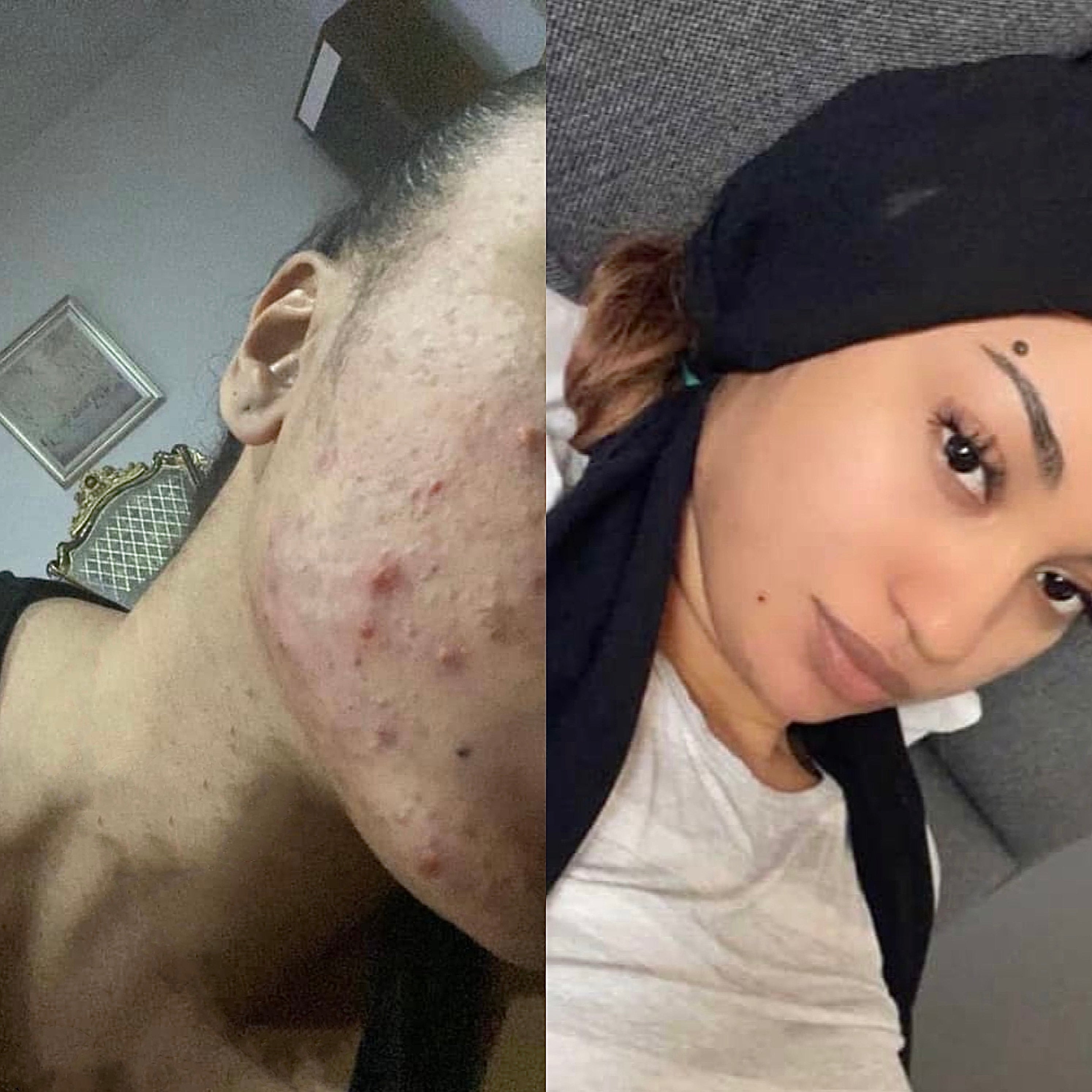 MUST READ! BYE BYE ACNE – Sival Skn